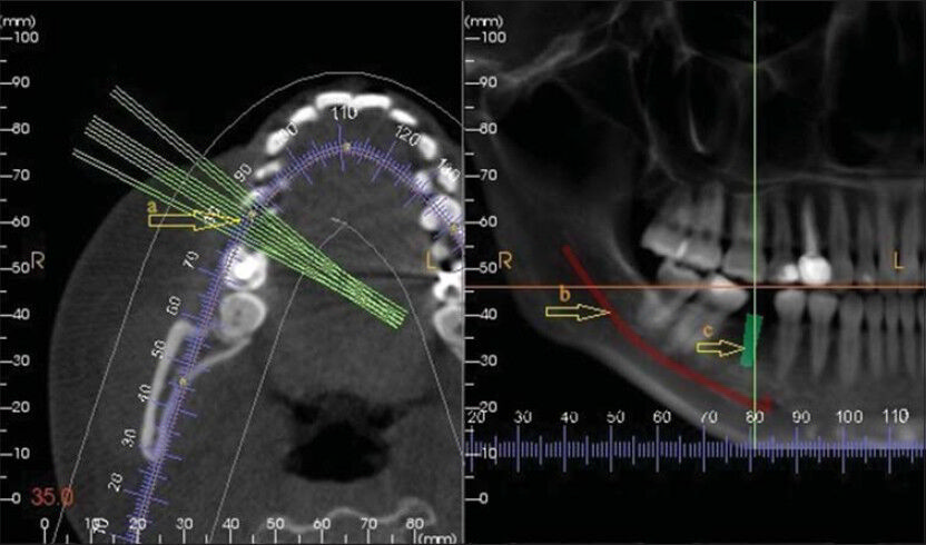 Diagnostic Imaging for Dental Implant Therapy - Journal of Clinical ...